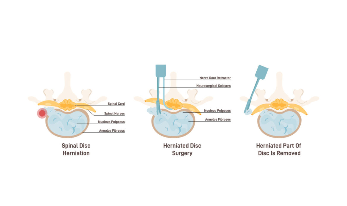 Microdiscectomy (Microdecompression) ☤ Dr. William McCormick, MD