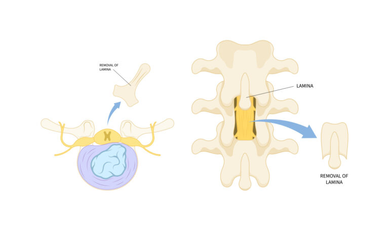 Laminectomy ☤ Dr. William McCormick, MD