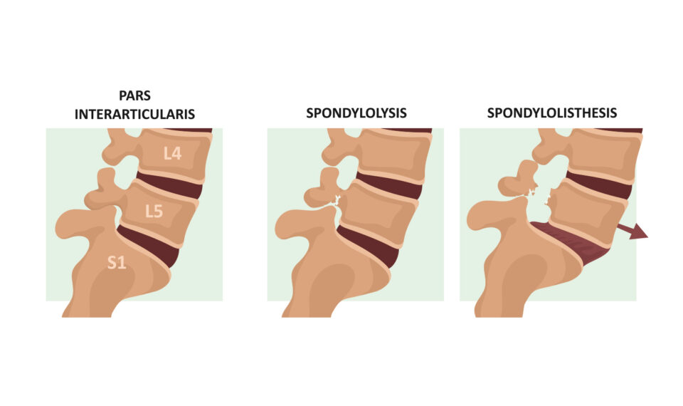 Spondylolysis and Spondylolisthesis ☤ Dr. William McCormick, MD